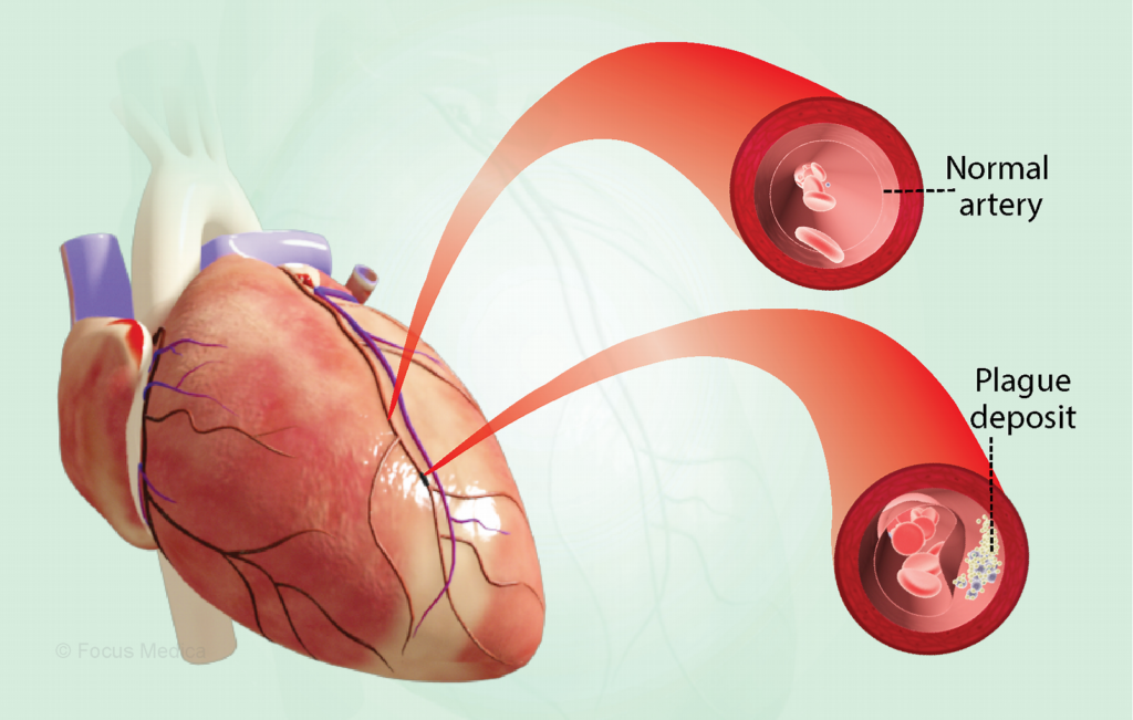 Arteriosclerosis / Atherosclerosis: Diagnosis and Treatment