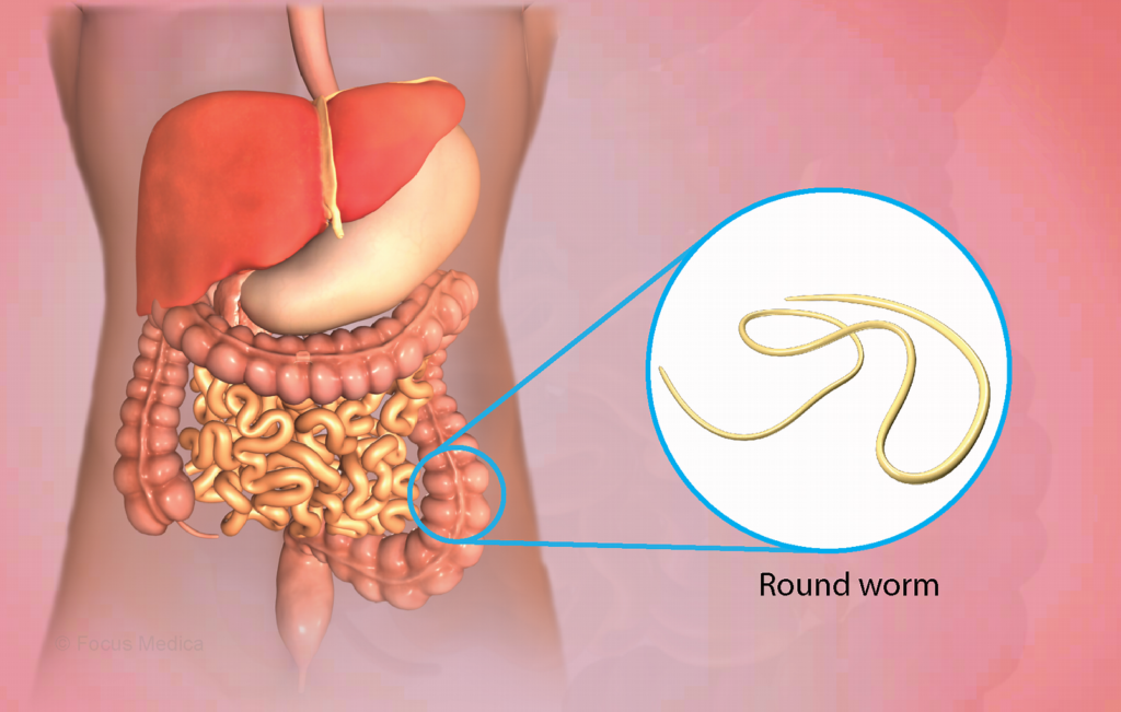 Ascariasis: Diagnosis and Treatment